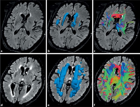 White Matter Hyperintensity and Vascular Disease from Biological Basis to Clinical Significance